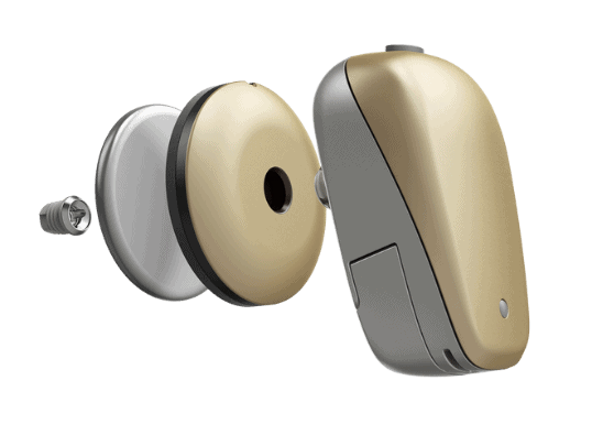 Hear the difference with Baha® 6 Max | Ear Science Institute Australia
